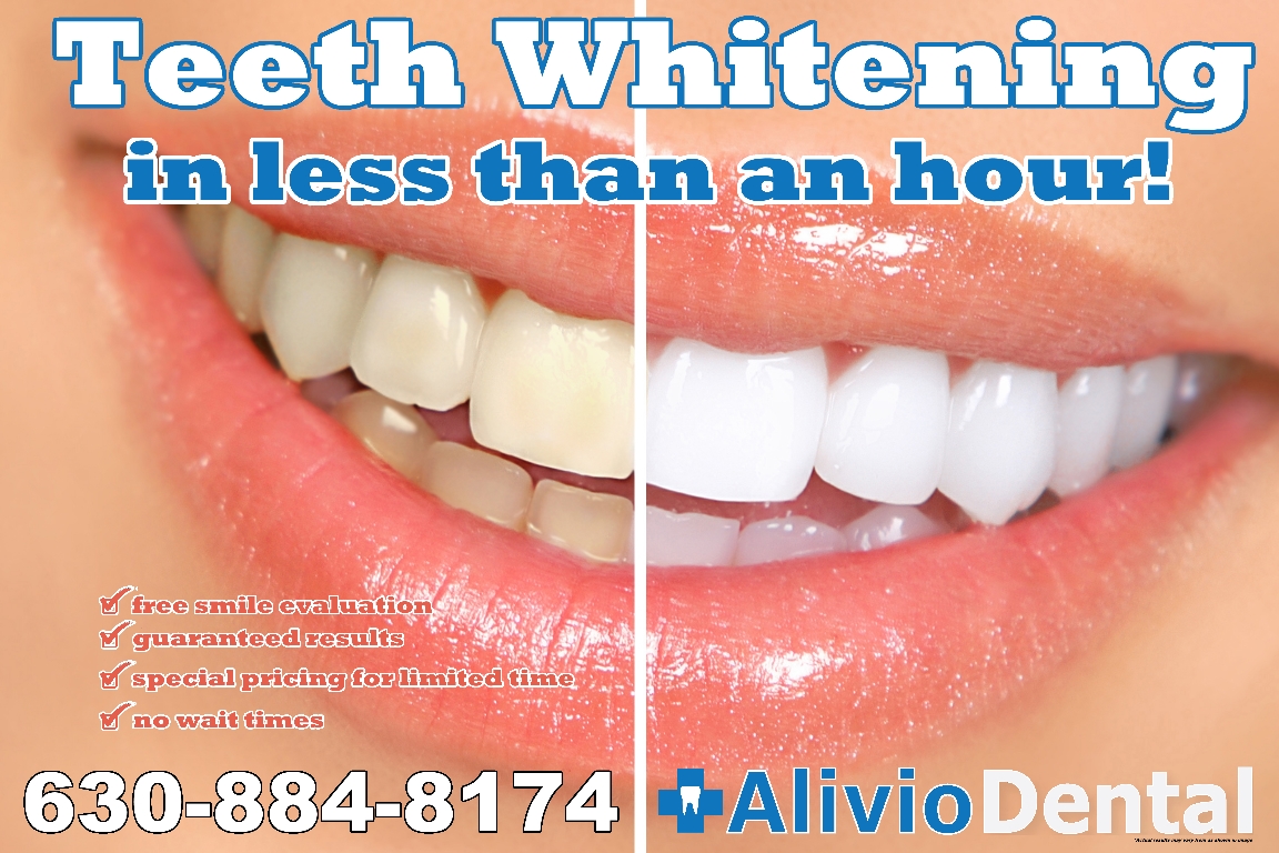 Teeth Whitening. Get brighter whiter smile in less than hour! – Dentist ...